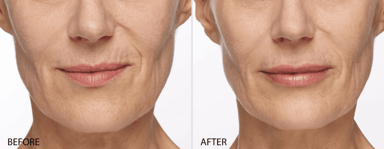 Restylane-L® - Dermatologists Of Birmingham